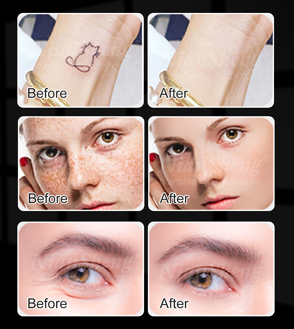 Picosecond Laser Treatment: What You Need to Know - Niansheng beauty ...